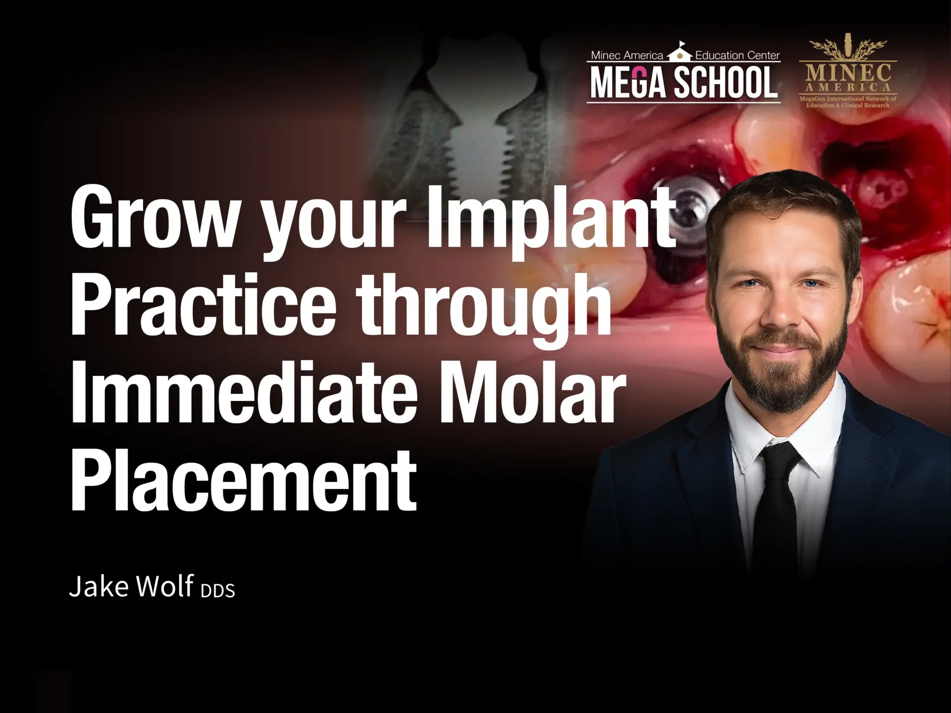 Grow your Implant Practice through Immediate Molar Placement - MINEC ...